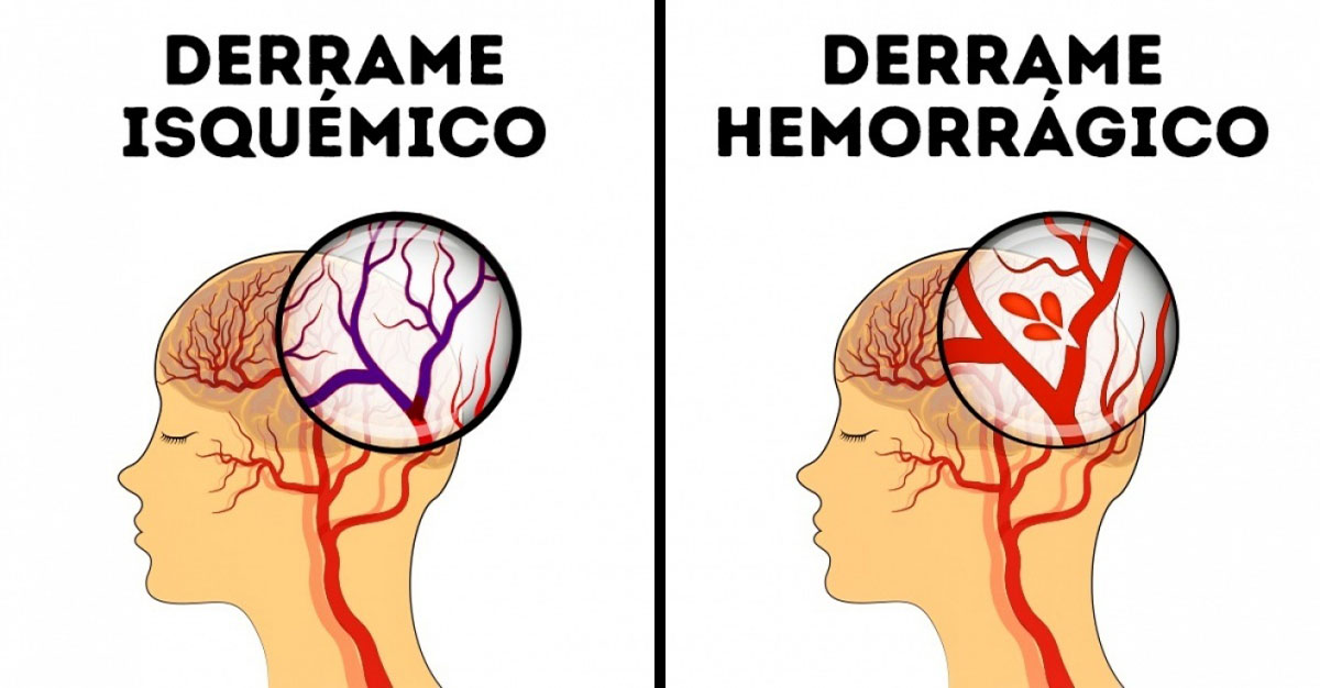 7 Síntomas Para Identificar Derrames Cerebrales En Mujeres Via Ritmo