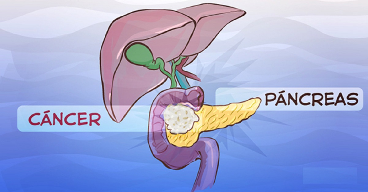 Cancer De Pancreas Sintomas
